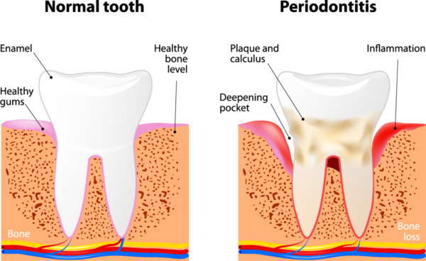 Periodontal treatment - Dr Ken Lipworth